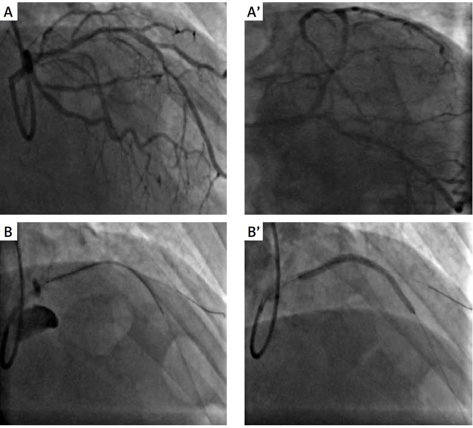 Intravascular ultrasonography guided 60-mm long drug-eluting tapered ...