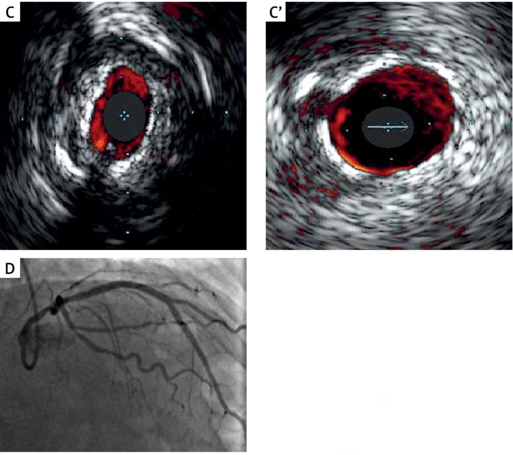 Intravascular ultrasonography guided 60-mm long drug-eluting tapered ...